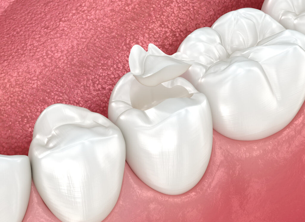 Spot the Signs: Tooth Cavity Causes Explained